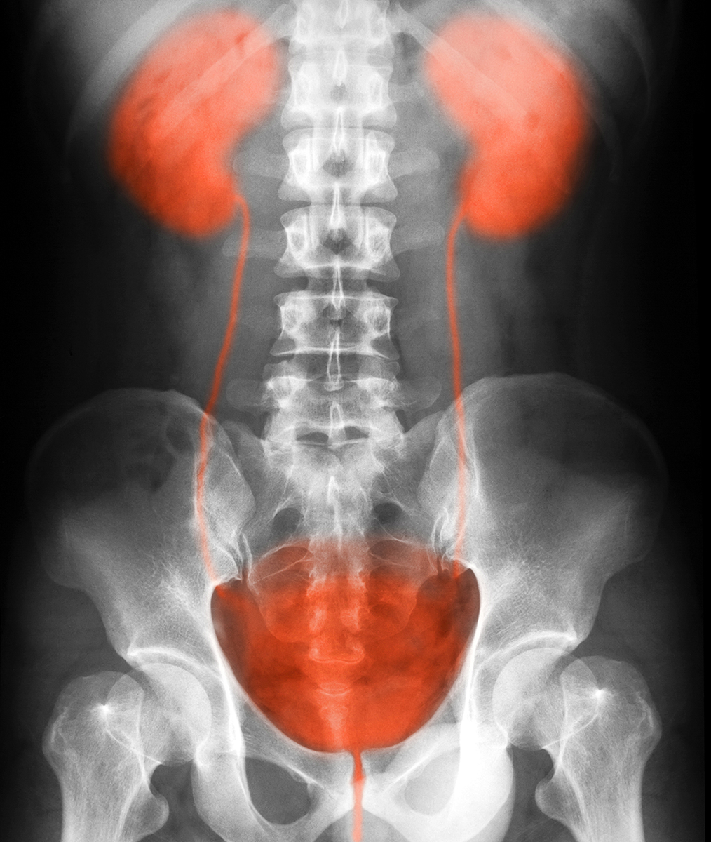 Pielonefritis aguda - Telenefrología | Salud Renal